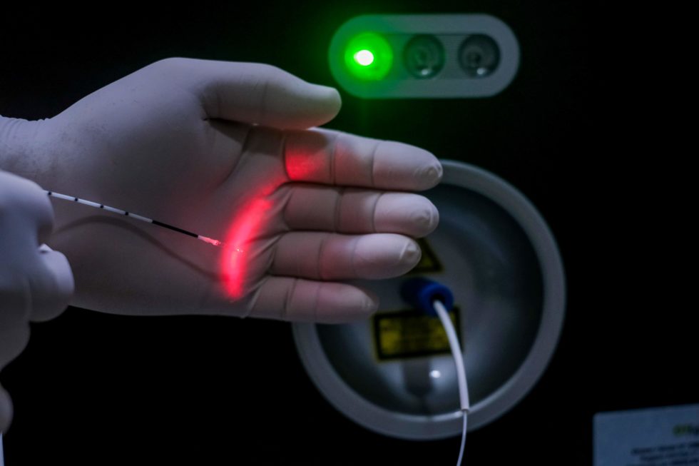 Laser Endovenoso para Tratamento de Safenas | Dr. Arlei A. Belaus | Brasil